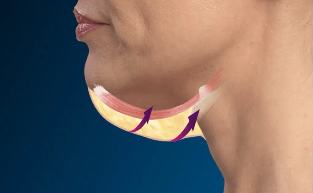 Traiter un double menton